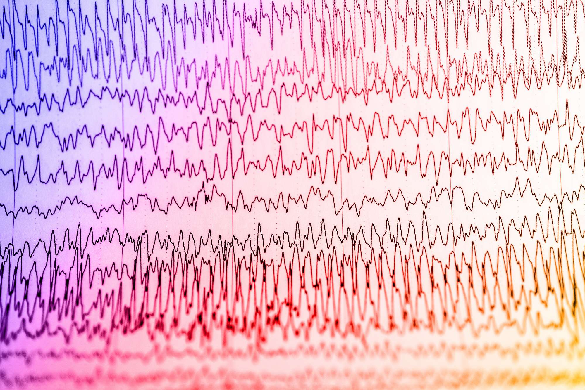 EEG als biomarker? | De Psycholoog